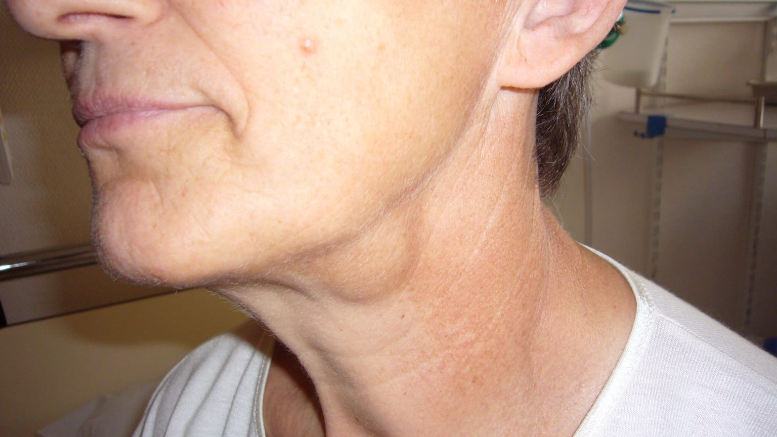 ENT salivary gland surgery: all procedures | Dr Delagranda