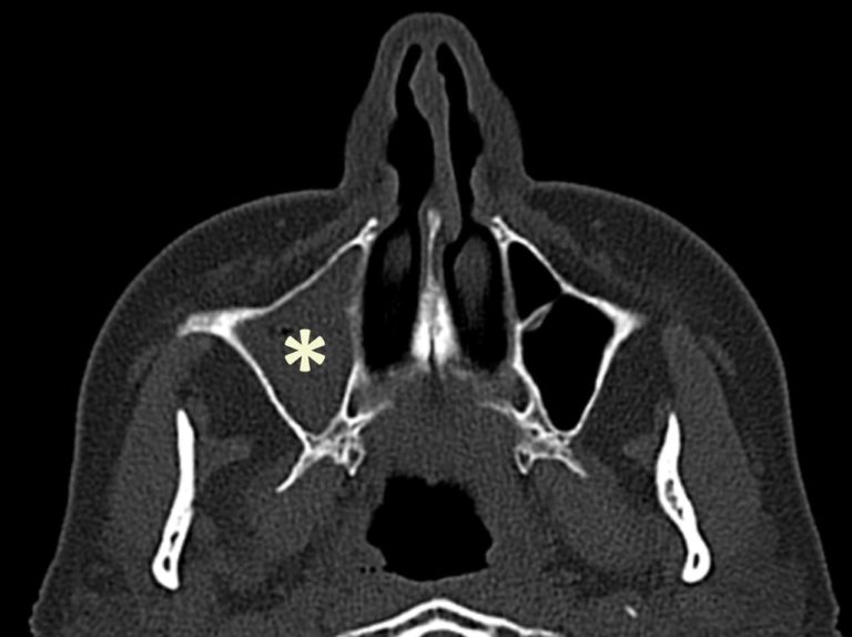 Endonasal middle meatotomy | Opening the maxillary sinus