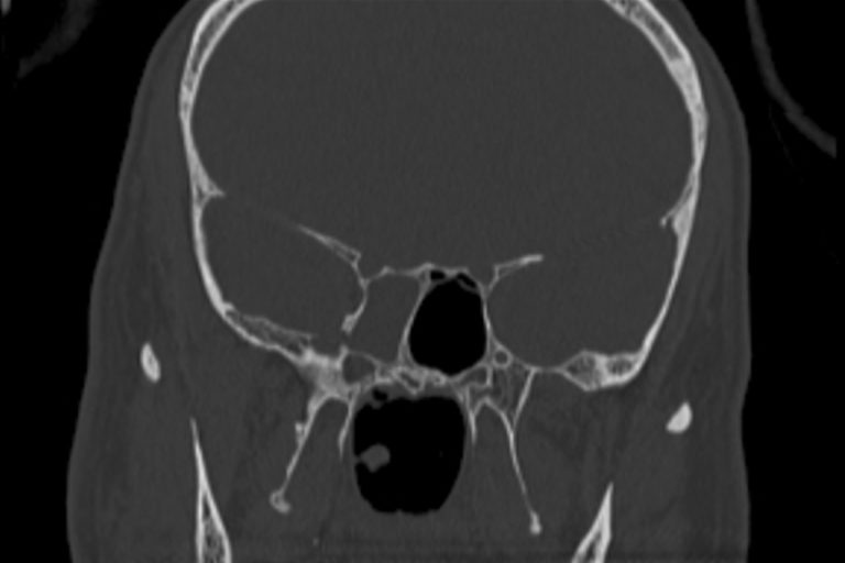 Endonasal sphenoidotomy | Dr Delagranda