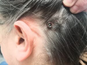 Prothèse auditive à ancrage osseux | Prothèse par implant ostéointégré